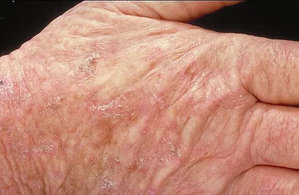 Summerland Skin Cancer Clinic | » Sun Spots